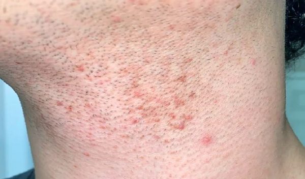 How to Prevent and Deal with Razor Burn from Electric Shavers - Wet ...